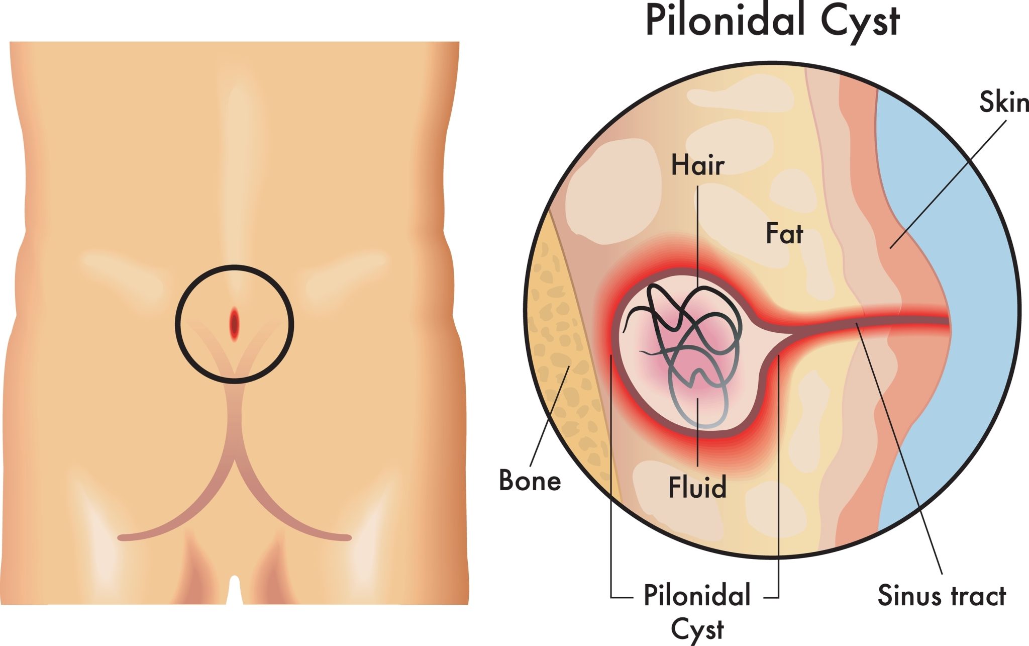 Why Pilonidal Cysts Keep Coming Back